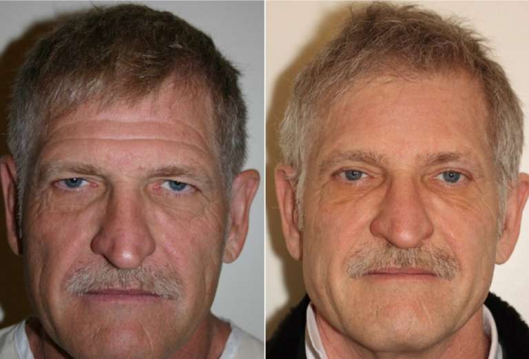 Brow Lift Surgical Procedure - Endoscopic Approach - Dr. Denton