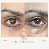 24-Lower-eyelid-skin-pinch-thumbnail - Dr. Denton