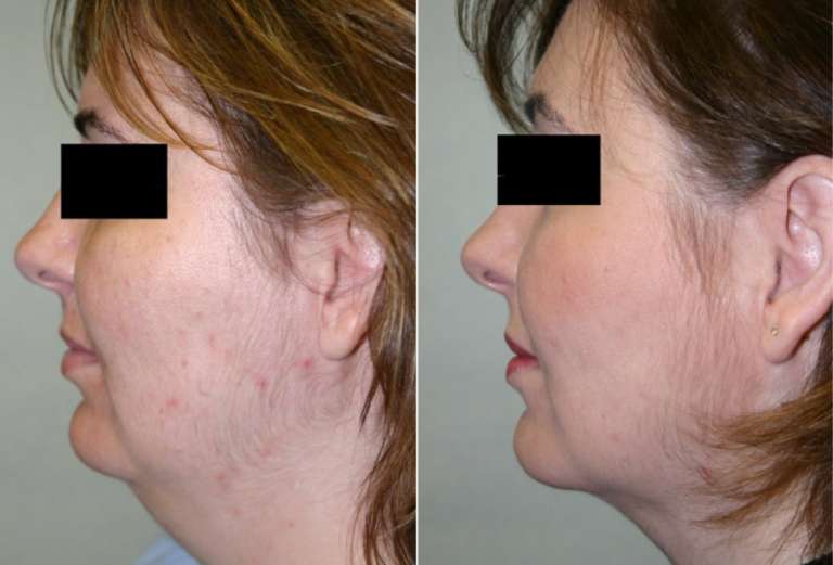 9-Facial-Liposuction - Dr. Denton