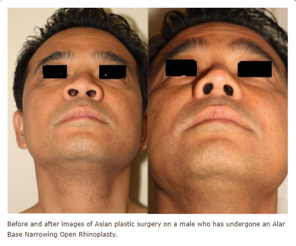 Alar Base Narrowing Vancouver | Rhinoplasty | Dr Denton